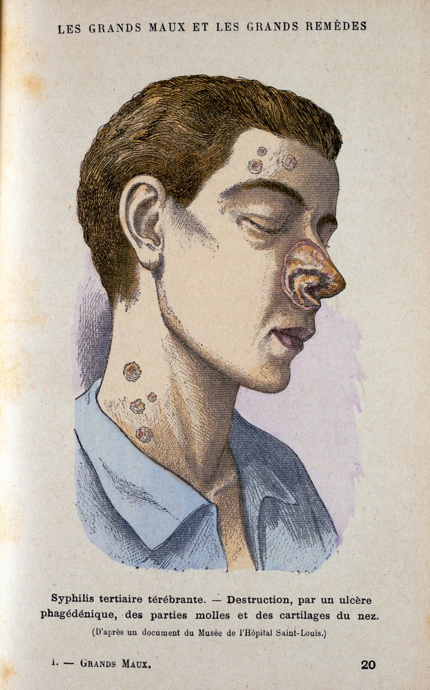 Tertiary Syphilis Face Man Suffering From Tertiary Syphilis, Paris,