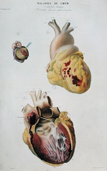 Plate depicting heart diseases. Spontaneous rupture of the heart of an ...