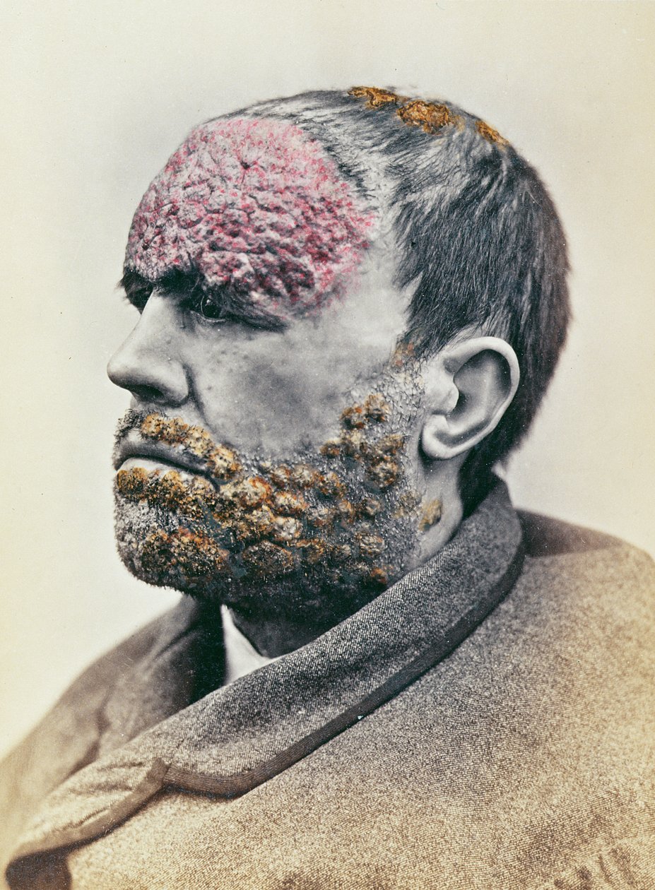 Man suffering from syphilis, from a photograph taken for the Clinique ...