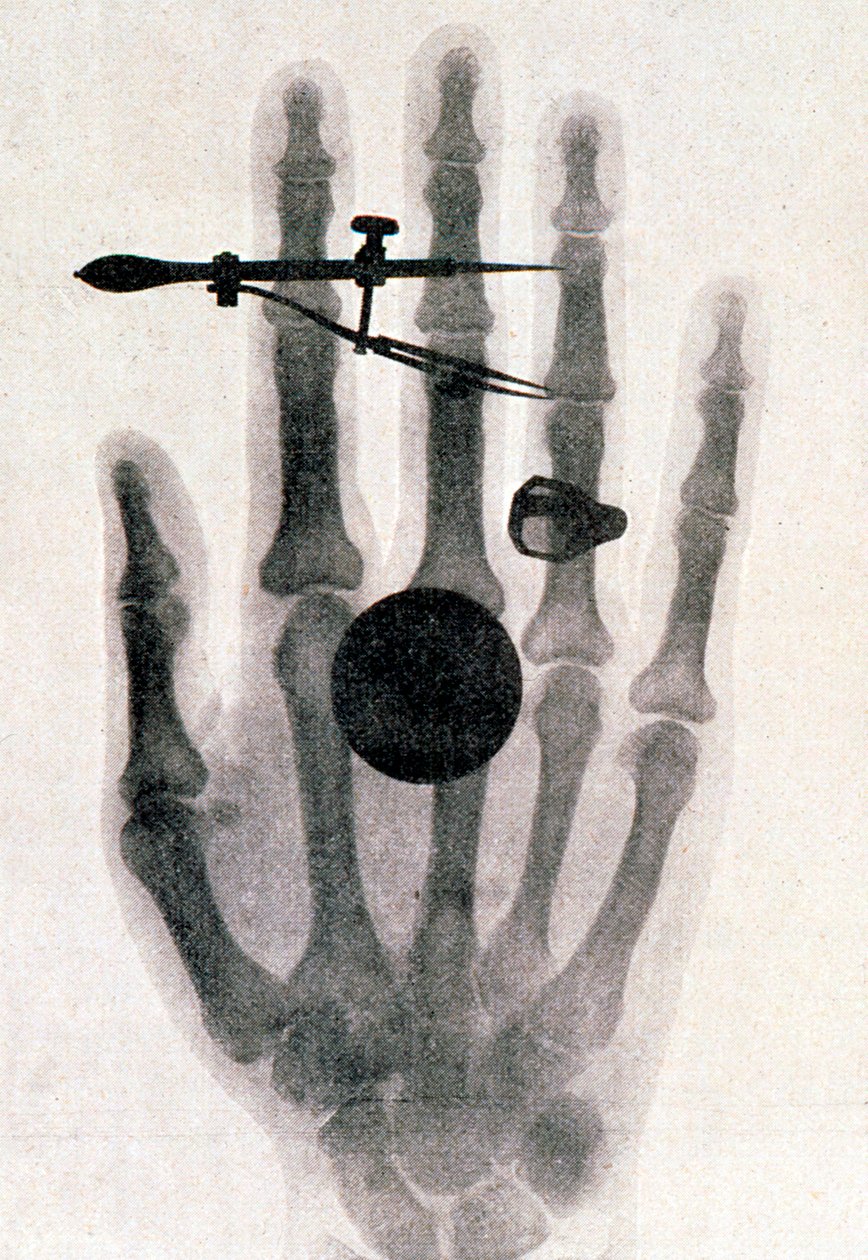 Wilhelm Roentgen's X-ray Photograph of His Wife's Hand, 1896