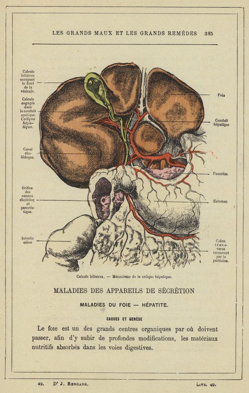 Gallstones, Mechanism of Hepatic Colic by French School